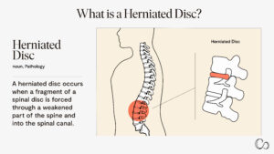 Signs a Herniated Disc Is Healing: The Ultimate Guide to Recovery ...