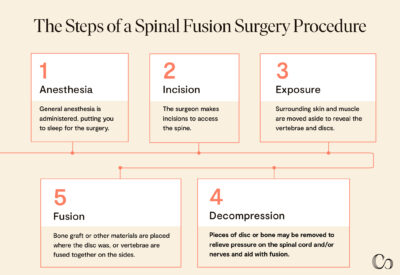 Spinal Fusion 101: Understanding Spinal Fusion Surgery - Commons Clinic