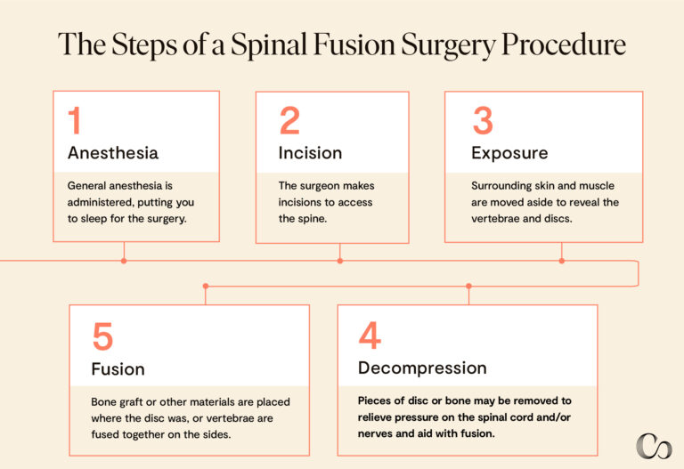 Spinal Fusion 101: Understanding Spinal Fusion Surgery - Commons Clinic