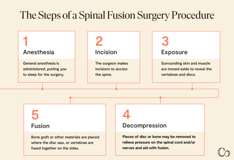 Spinal Fusion 101: Understanding Spinal Fusion Surgery - Commons Clinic