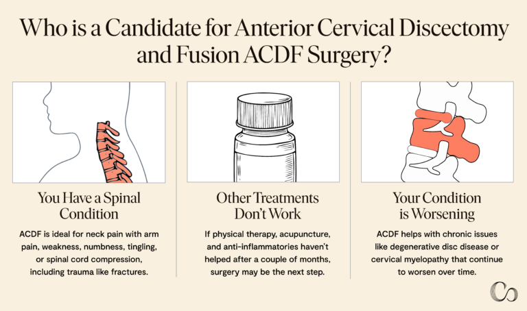 Anterior Cervical Discectomy & Fusion (ACDF) for Neck Pain - Commons Clinic