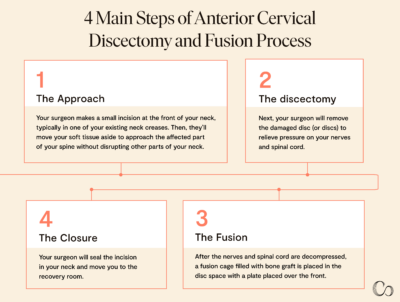 Anterior Cervical Discectomy & Fusion (ACDF) for Neck Pain - Commons Clinic