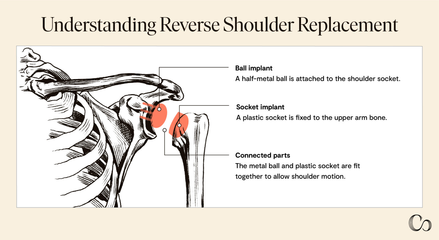 Reverse Shoulder Replacement Surgery 101: In-depth Guide - Commons Clinic