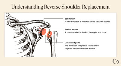 Reverse Shoulder Replacement Surgery 101: In-depth Guide - Commons Clinic