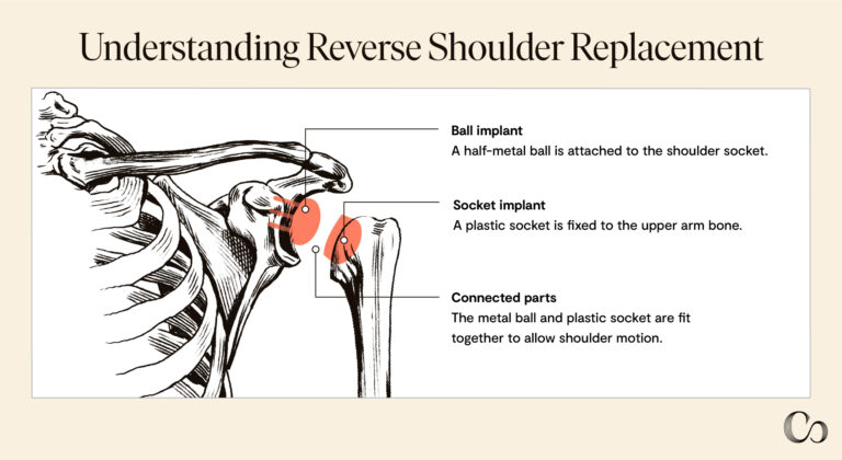 Reverse Shoulder Replacement Surgery 101: In-depth Guide - Commons Clinic