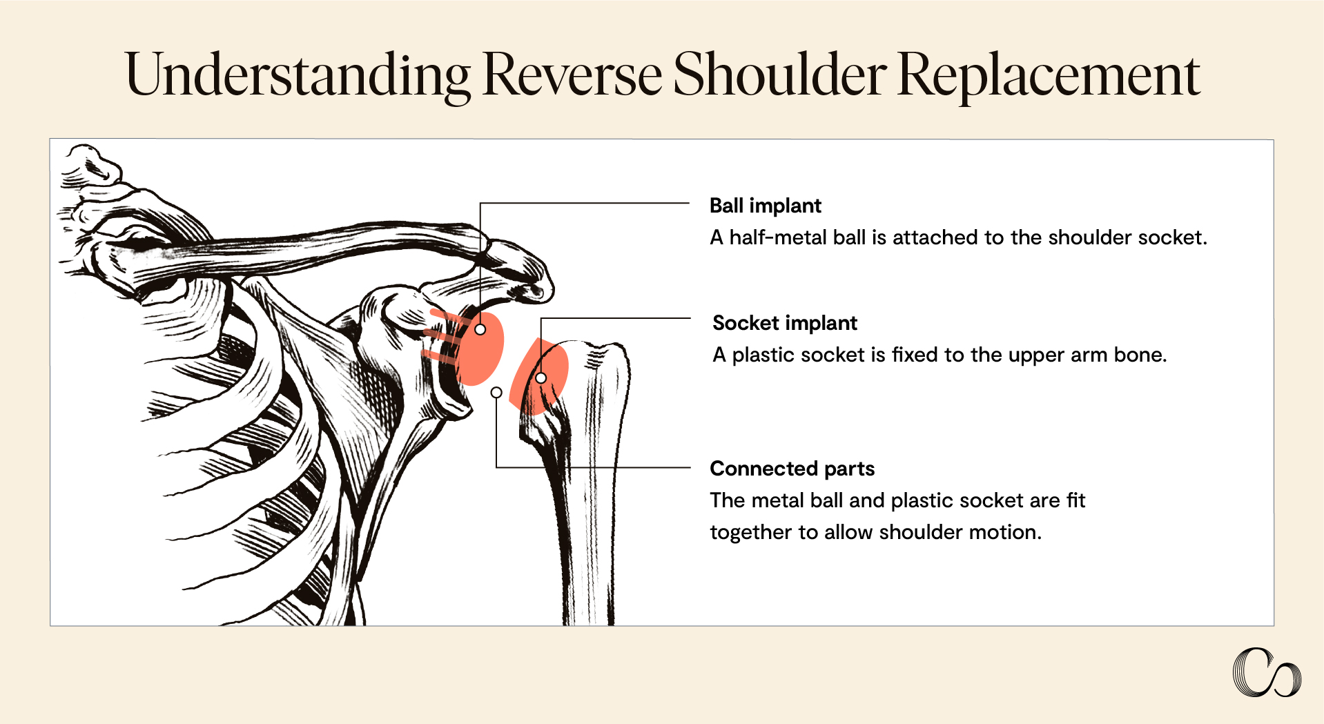 Reverse Shoulder Replacement Surgery 101: In-depth Guide - Commons Clinic