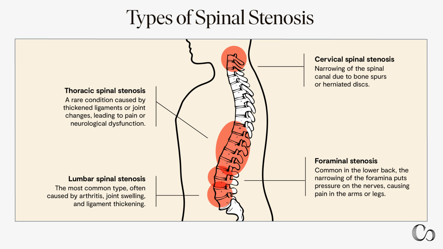 The 5 Most Innovative Treatments for Spinal Stenosis - Commons Clinic