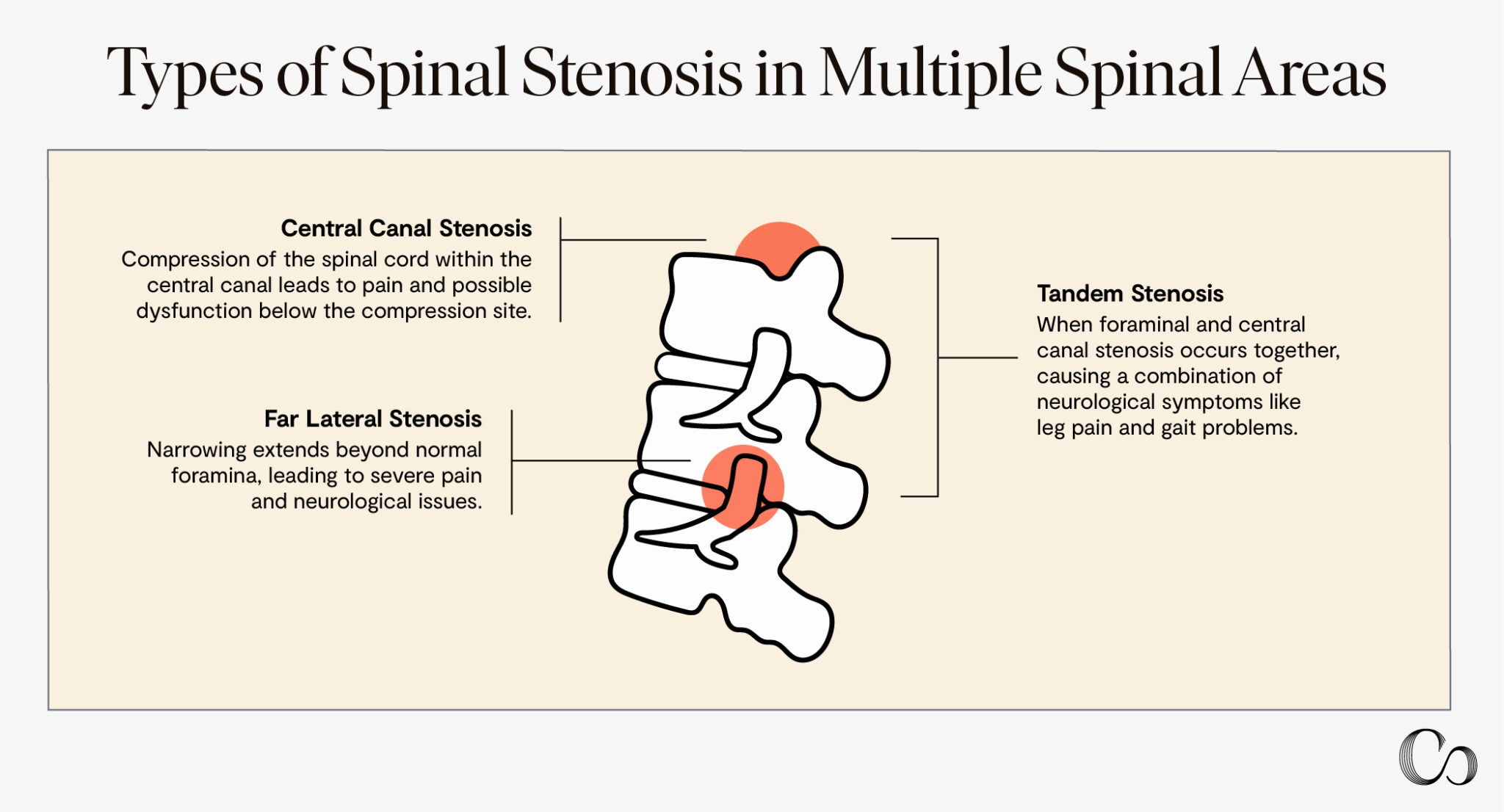 The 5 Most Innovative Treatments for Spinal Stenosis - Commons Clinic