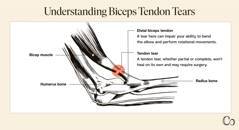 Guide to Biceps Tendon Repair: Causes, Symptoms, and Surgery - Commons ...
