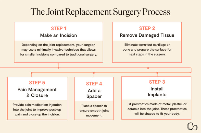 Total Joint Replacement Surgery 101 - Commons Clinic